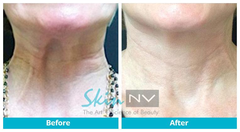 Before and After Skin Care Treatments South Tampa, FL