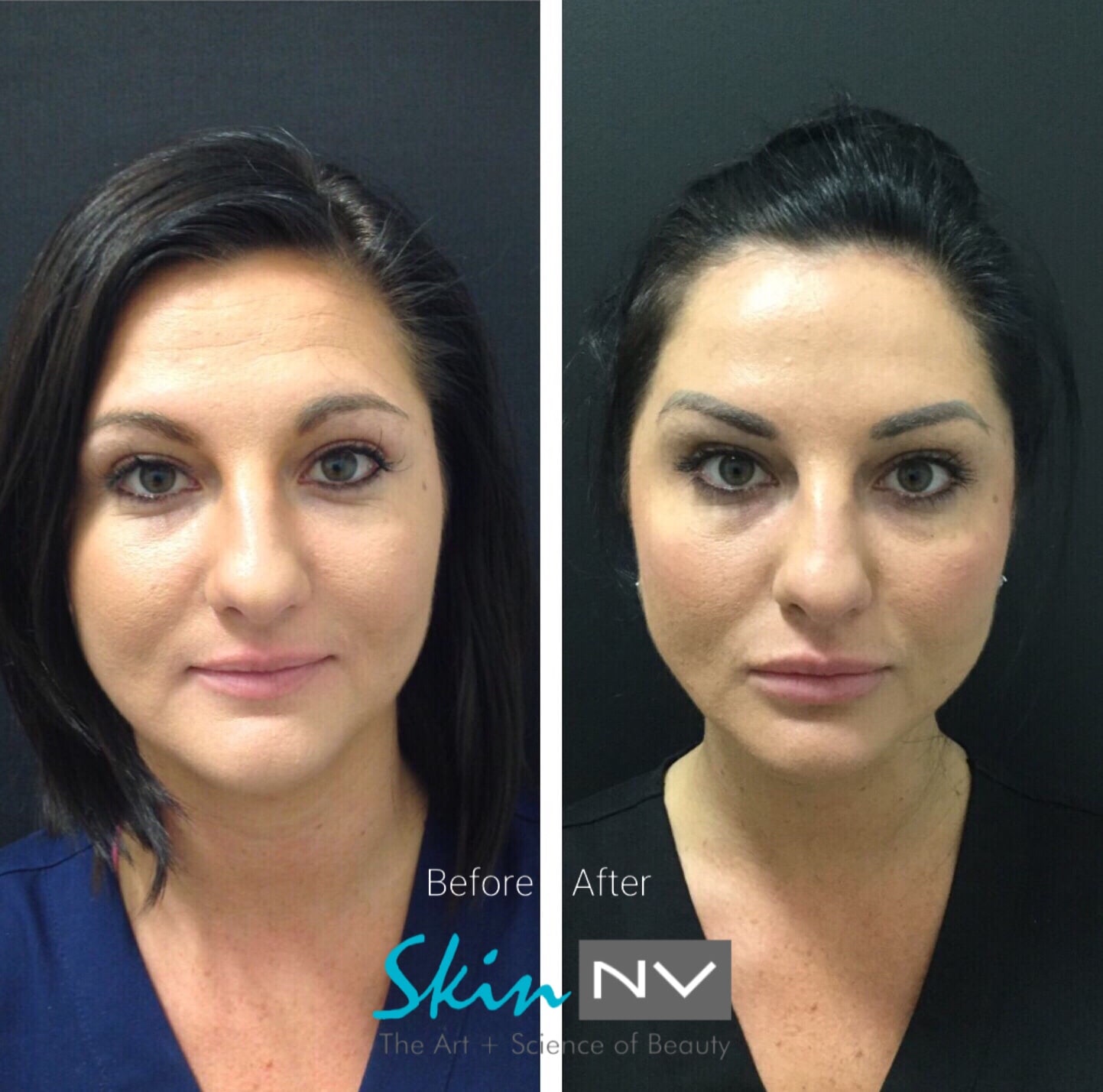 Before & After | SkinNV