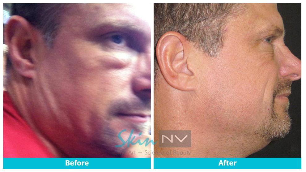 Before & After | SkinNV