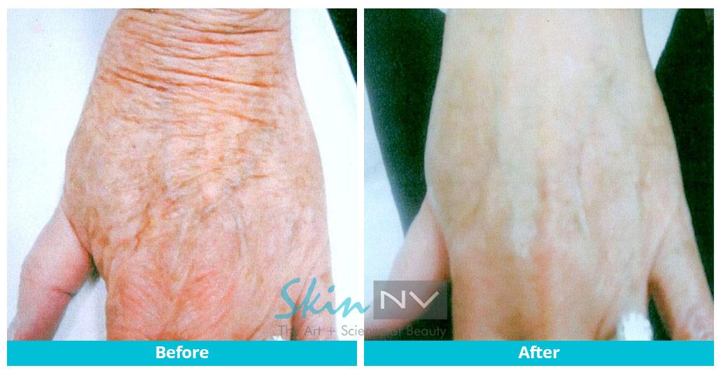 Before & After | SkinNV