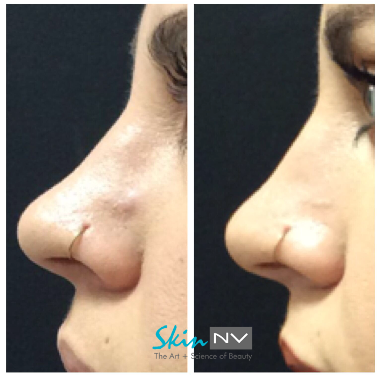 Before & After Gallery | Tampa Fillers, Botox, Lasers & More | Skin NV