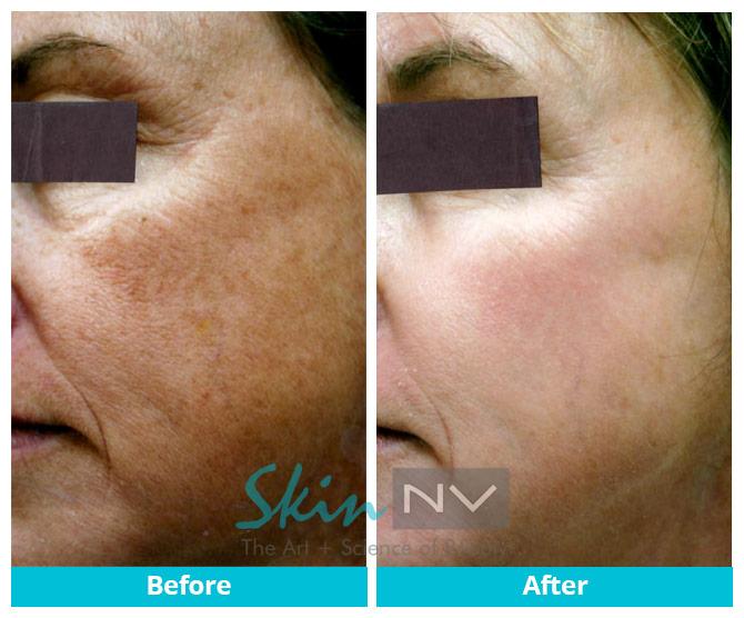 Before & After | SkinNV