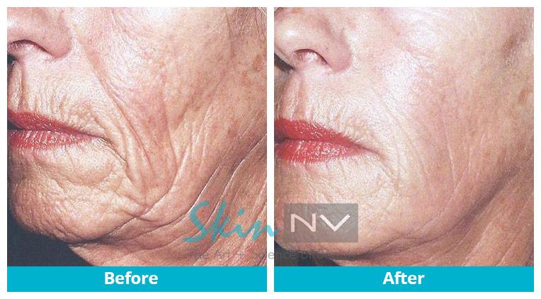 Before & After Gallery | Tampa Fillers, Botox, Lasers & More | Skin NV