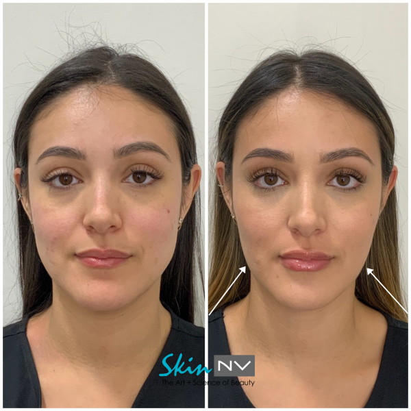 Non-Surgical Face Slimming - Skin NV Tampa Med Spa