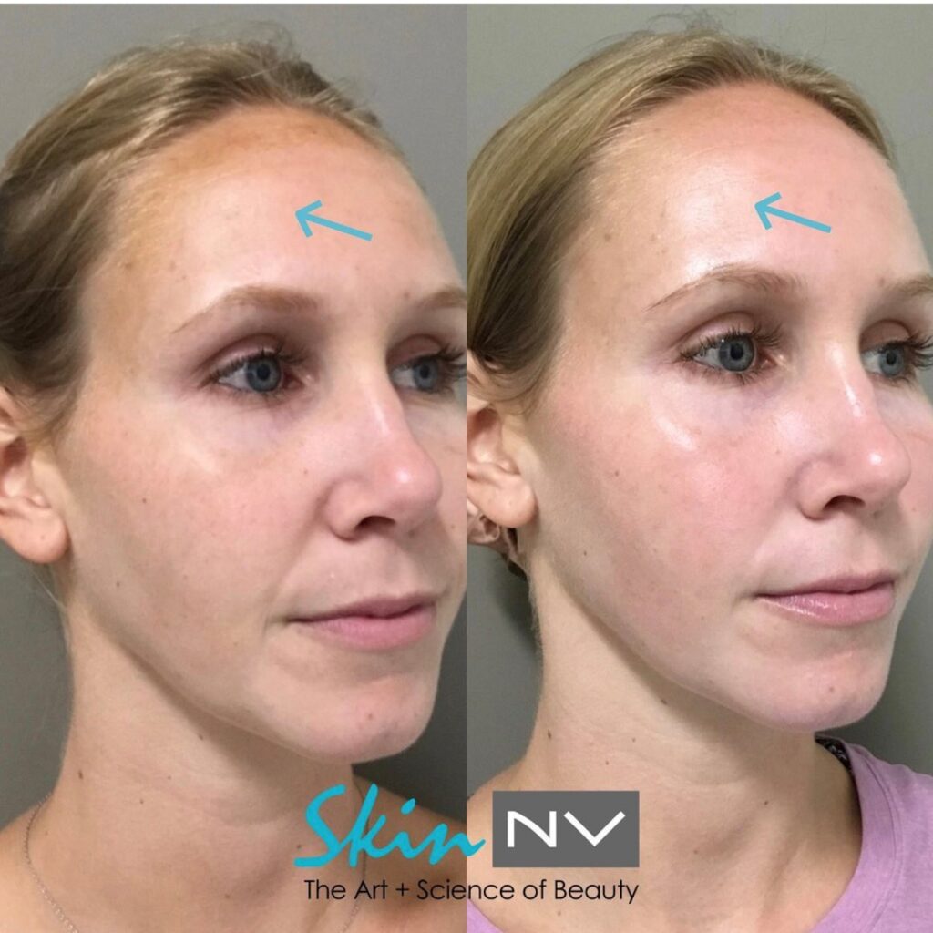 South Tampa Medical Grade Peels Skin Rejuvenation