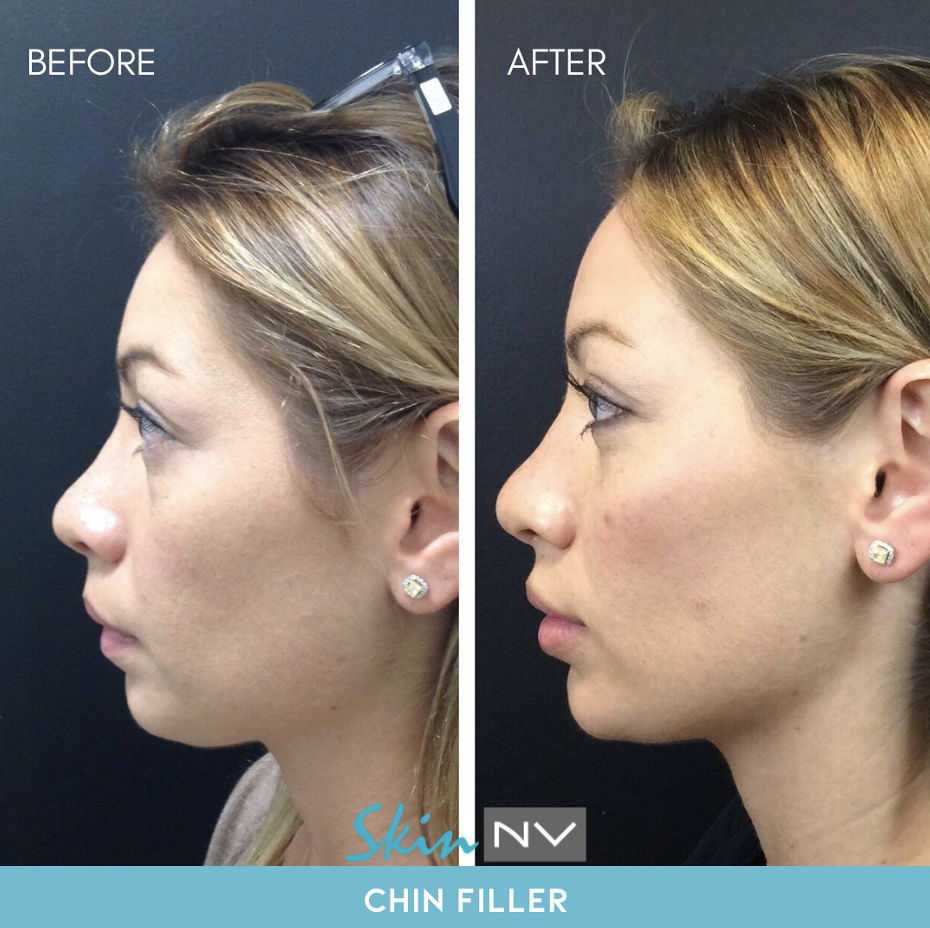 3 Ways to Slim Your Face (Non-Surgically) - Skin NV Tampa Med Spa