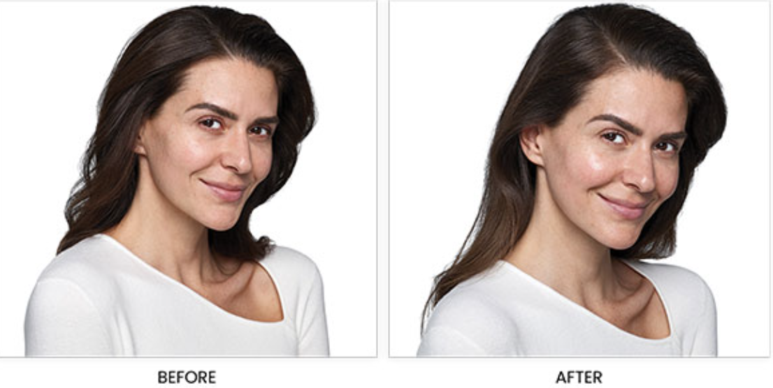 Introducing SkinVive: Hydrating Injectable at Skin NV - Skin NV Tampa ...