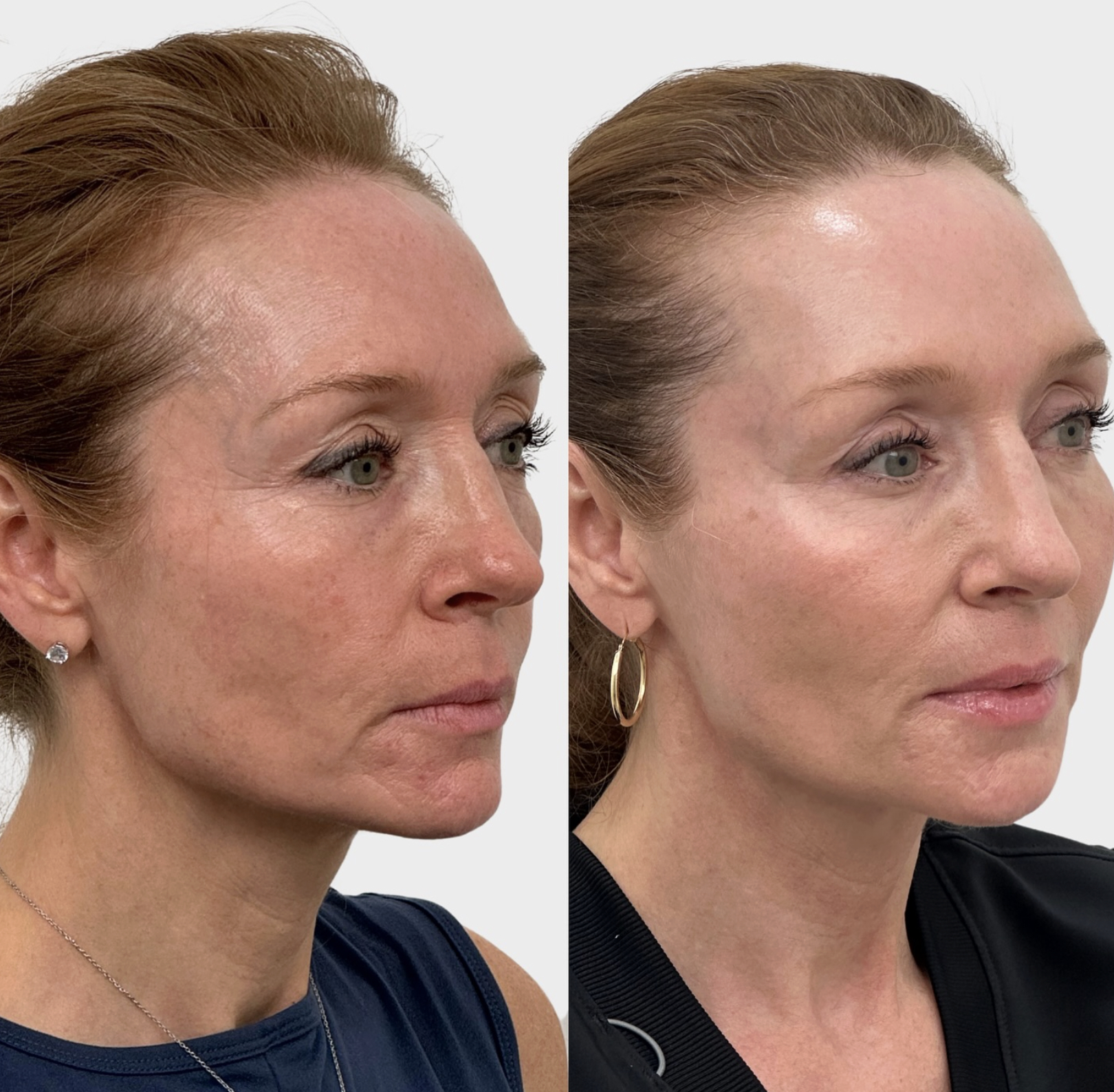 Best Tampa Microneedling Add-Ons | Skin NV Guide