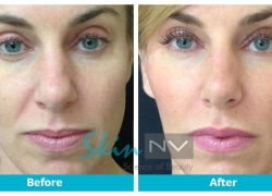 Before & After | SkinNV