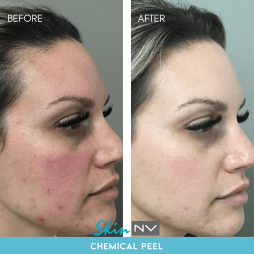 South Tampa Medical Grade Peels Skin Rejuvenation