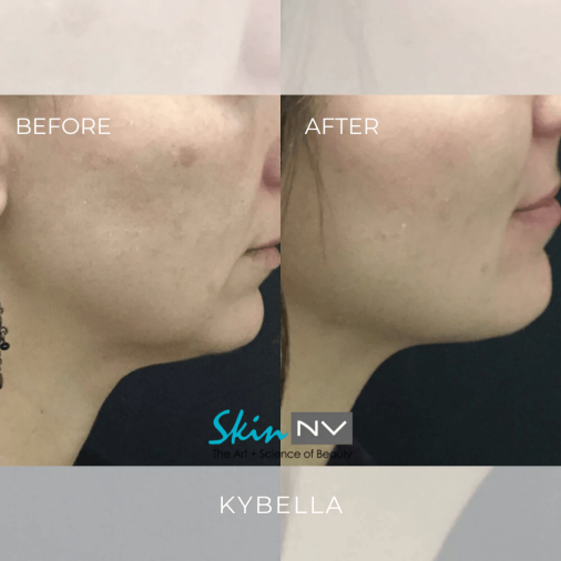 Tampa Kybella Injections - Remove Fat Below Chin and Neck
