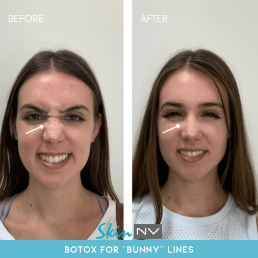 Tampa Botox Injections | Best Price on Botox in Tampa | Skin NV
