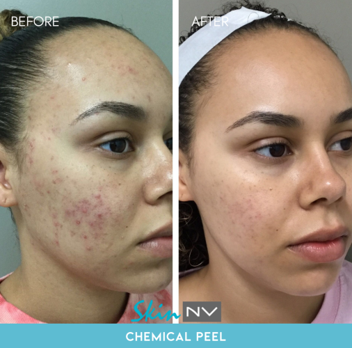 South Tampa Medical Grade Peels Skin Rejuvenation