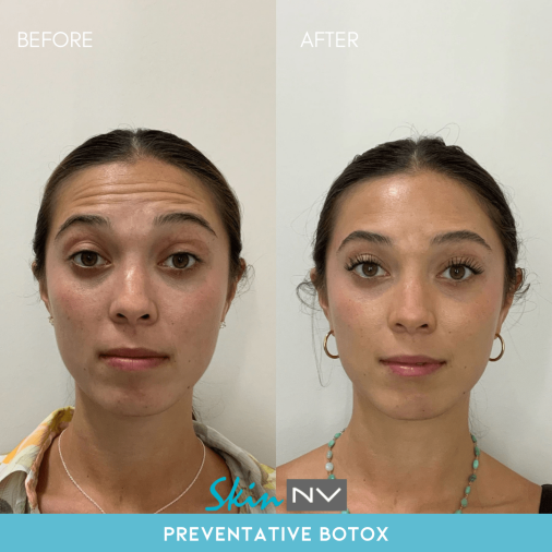 Tampa Botox Injections | Best Price on Botox in Tampa | Skin NV