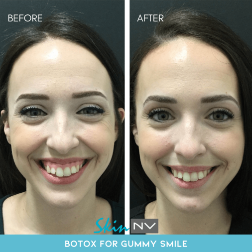 Tampa Botox Injections | Best Price on Botox in Tampa | Skin NV