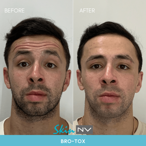 Tampa Botox Injections | Best Price on Botox in Tampa | Skin NV